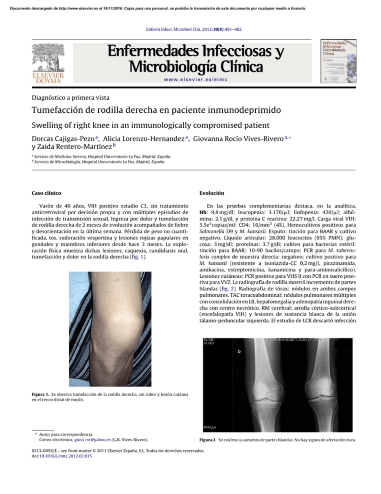 Tumefacción de rodilla derecha en paciente inmunodeprimido