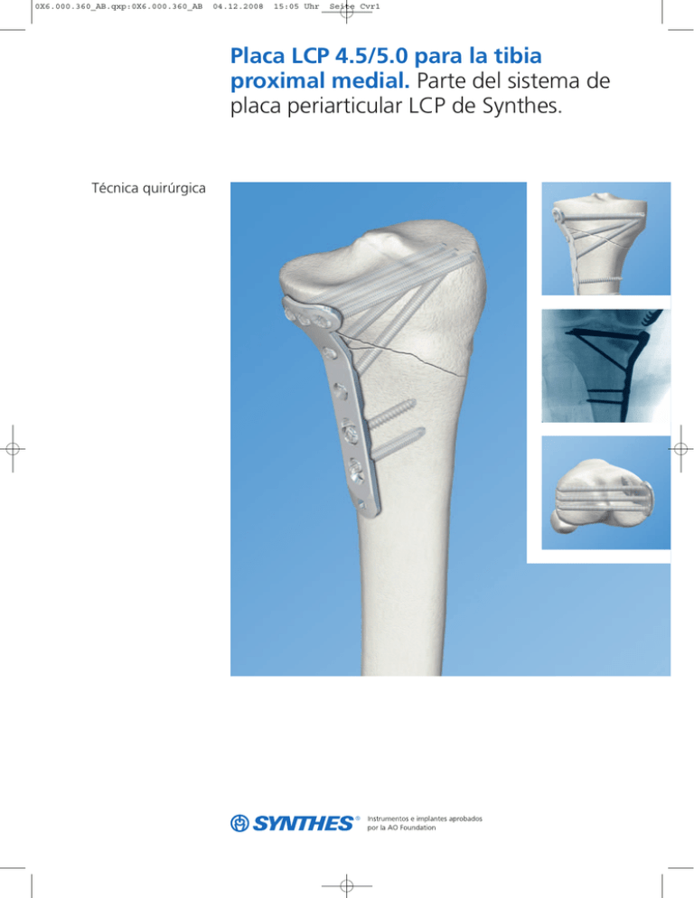 Placa LCP 4.5/5.0 para la tibia proximal medial. Parte del sistema