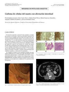 Linfoma primario de intestino delgado