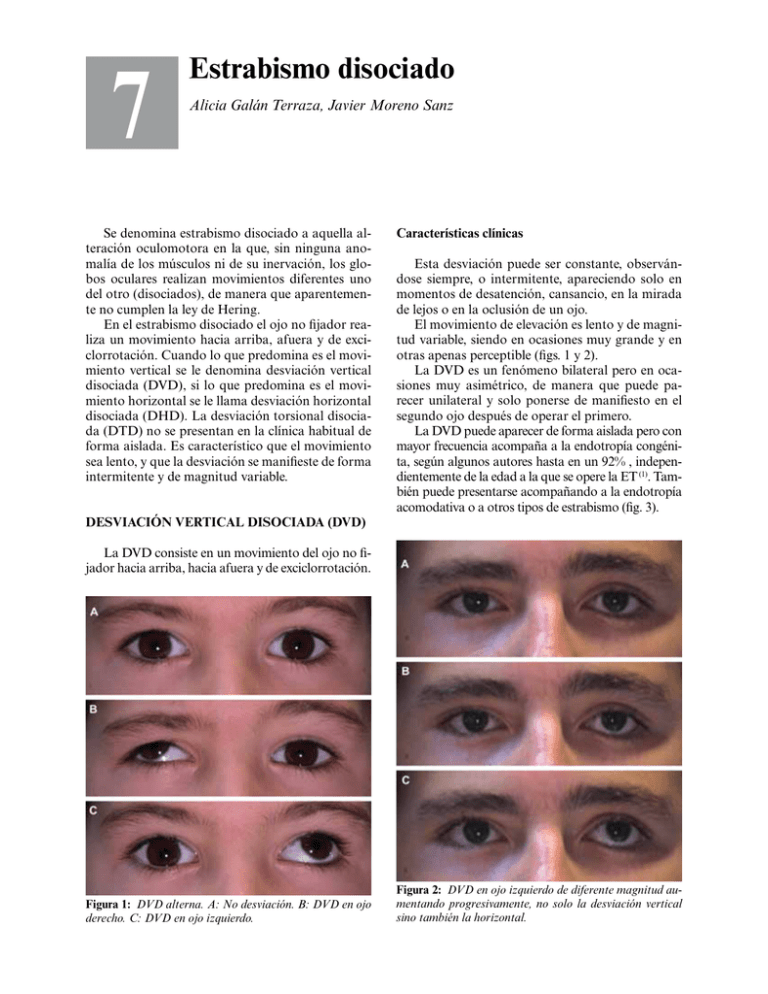 Estrabismo disociado