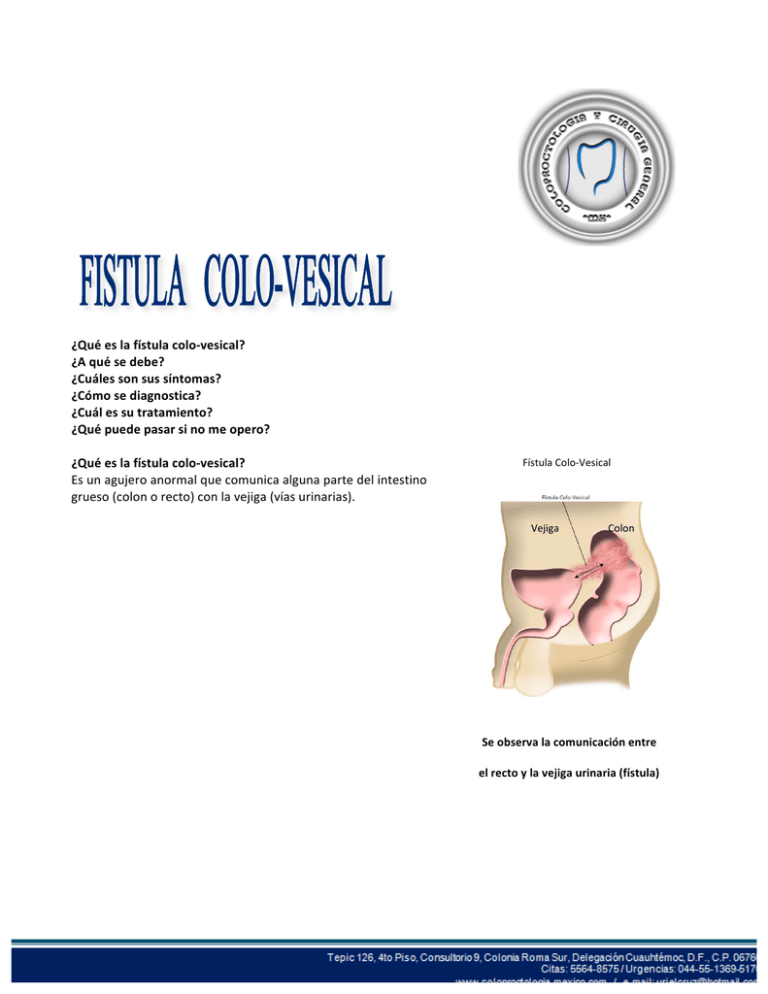 ¿qué Es La Fístula Colo‐vesical ¿a Qué Se Debe ¿cuáles Son Sus