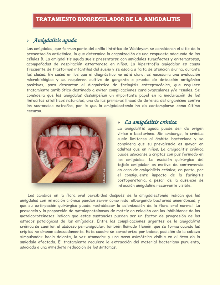 Amigdalitis aguda La amigdalitis crónica